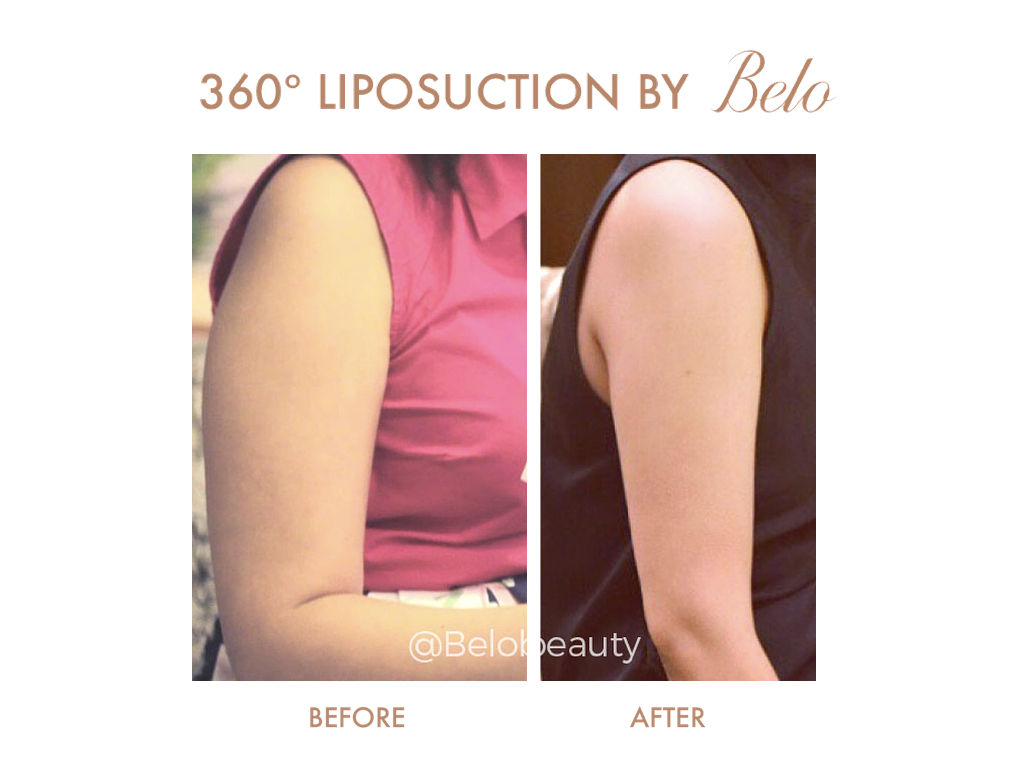 360 Liposuction: How It Works and Benefits | Lifestyle.INQ | Lifestyle.INQ