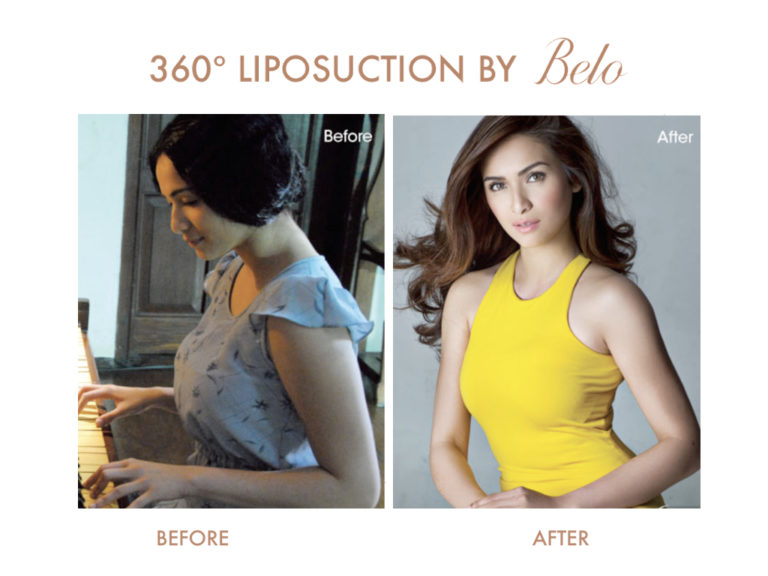 360 Liposuction: How It Works and Benefits | Lifestyle.INQ | Lifestyle.INQ